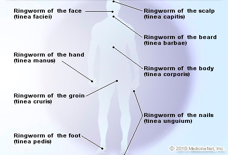 Communicable diseases- Ringworm | Create WebQuest